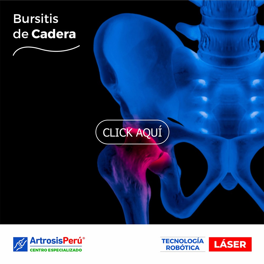 BURSITIS DE CADERA - Fundación Preventis