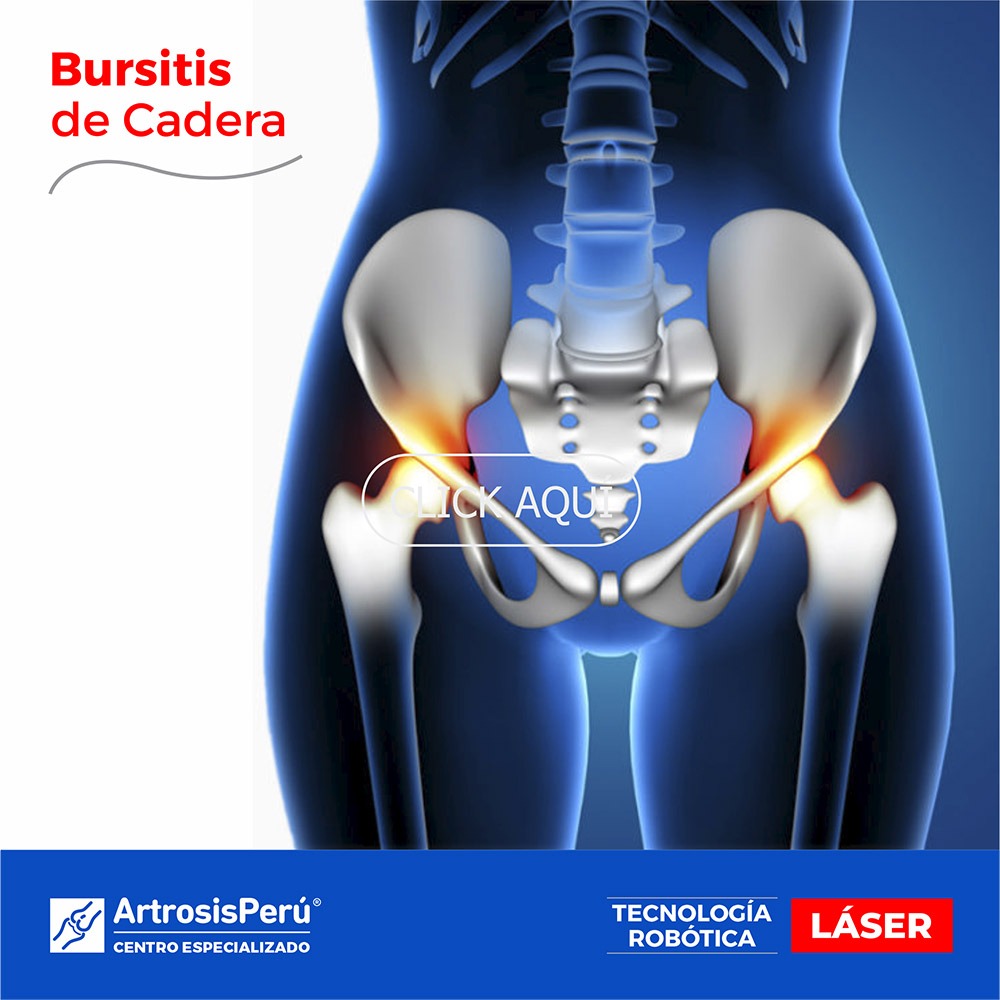 BURSITIS DE CADERA - Fundación Preventis