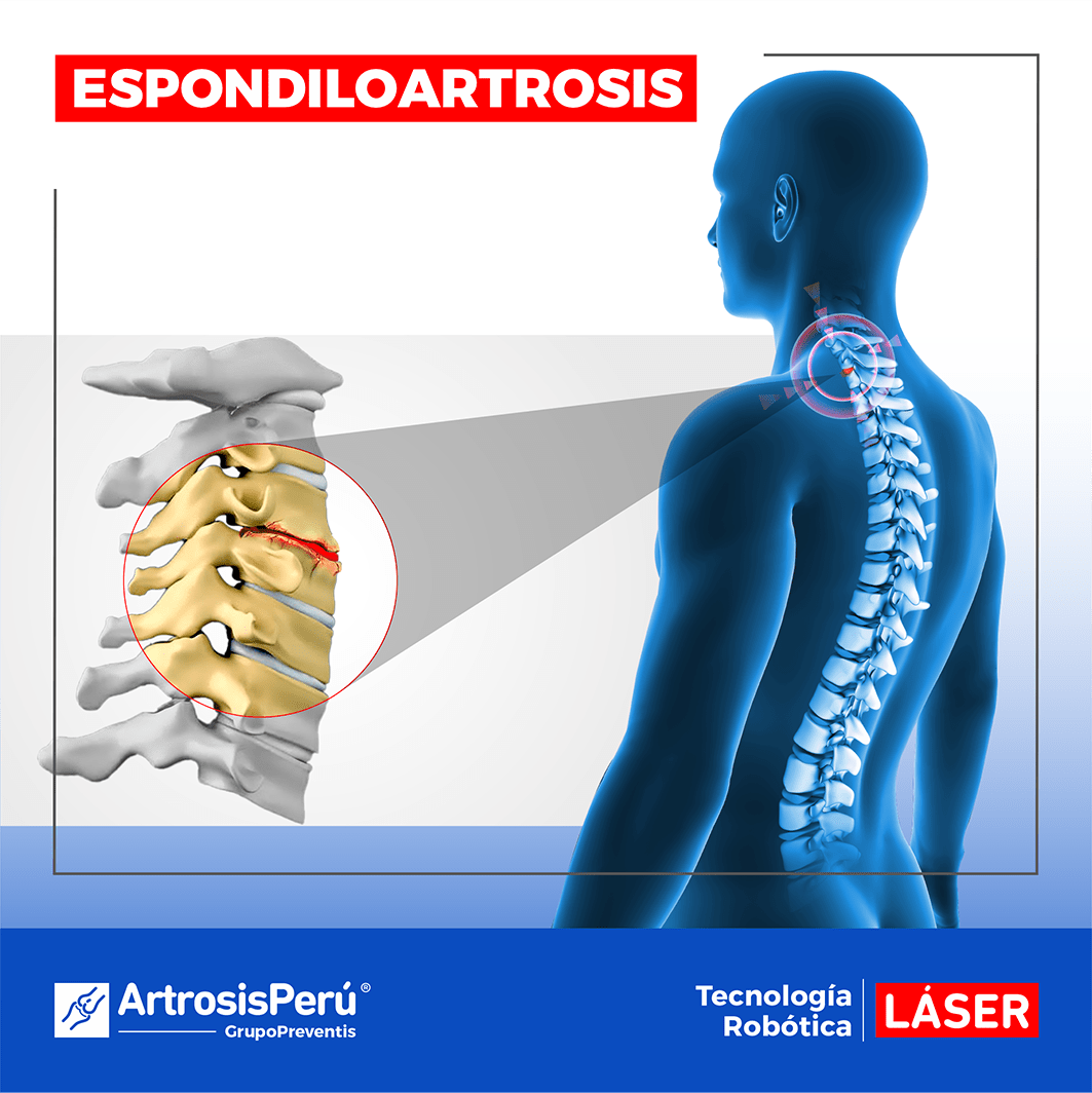 ESPONDILOARTROSIS - Fundación Preventis