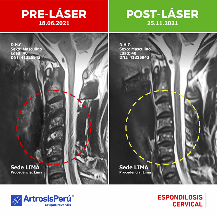 ESPONDILOSIS CERVICAL - Fundación Preventis