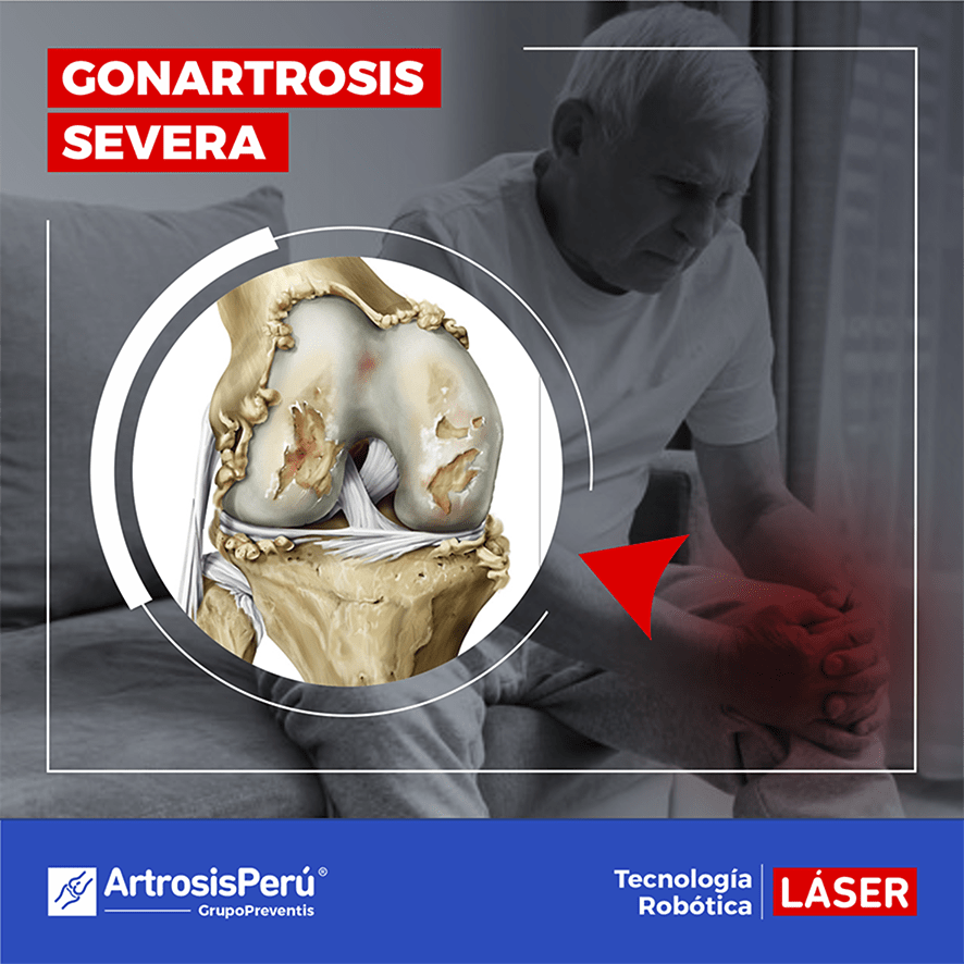 GONARTROSIS SEVERA - Fundación Preventis