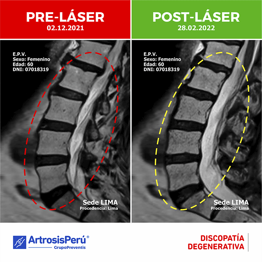 DISCOPATIA DEGENERATIVA - Fundación Preventis
