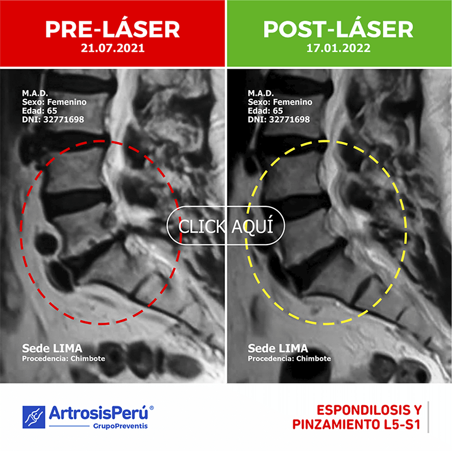 ESPONDILOSIS Y PINZAMIENTO L5-S1 - Fundación Preventis