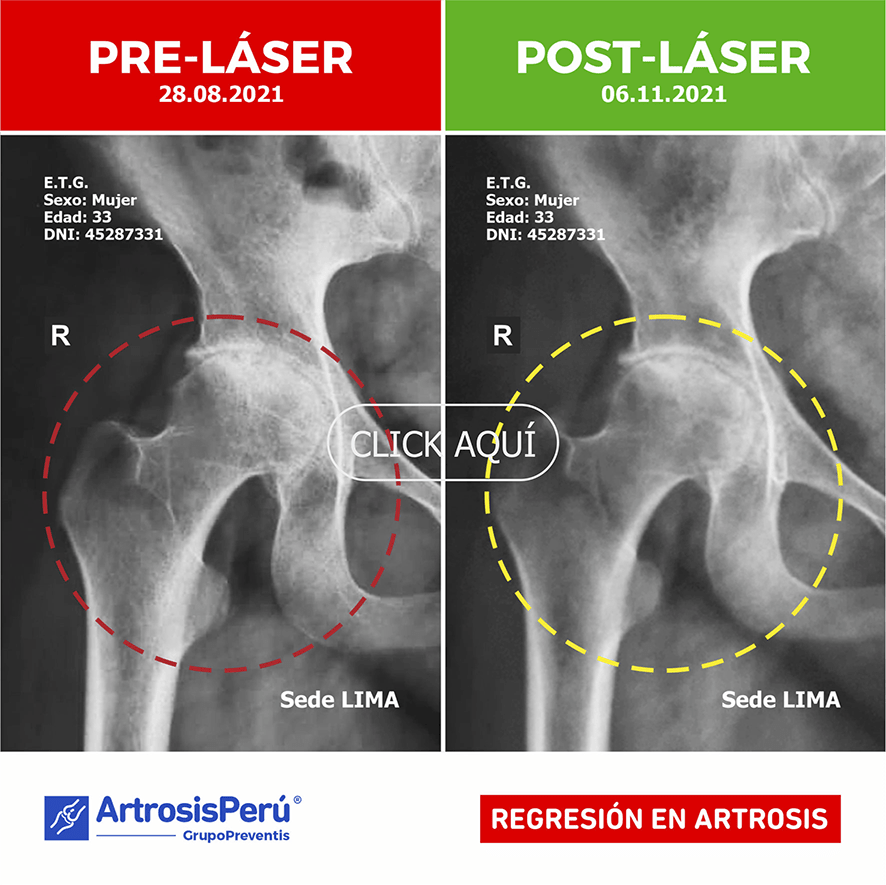 REGRESIÓN DE ARTROSIS - Fundación Preventis