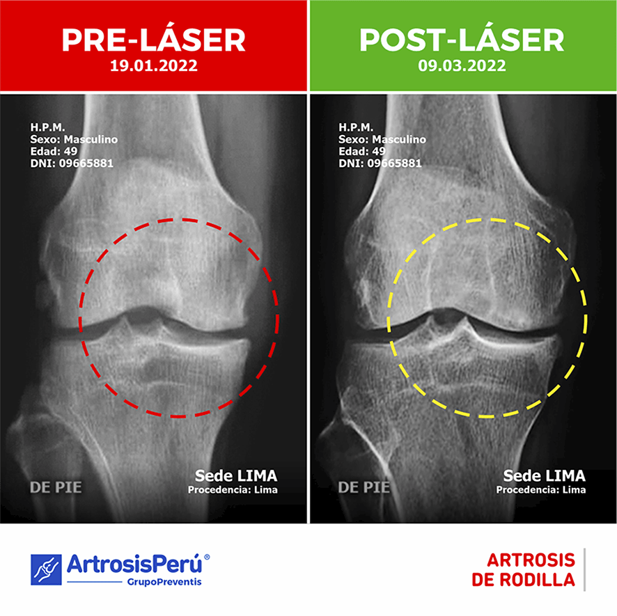 ARTROSIS DE RODILLA - Fundación Preventis
