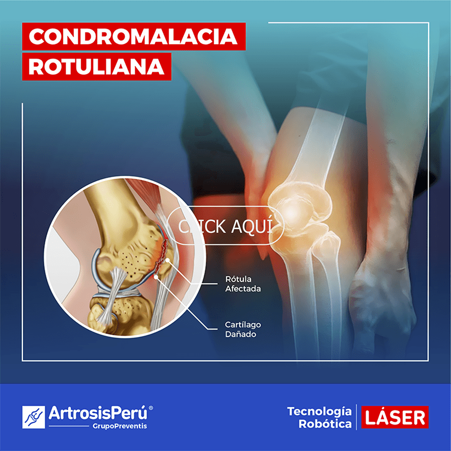 CONDROMALACIA ROTULIANA - Fundación Preventis