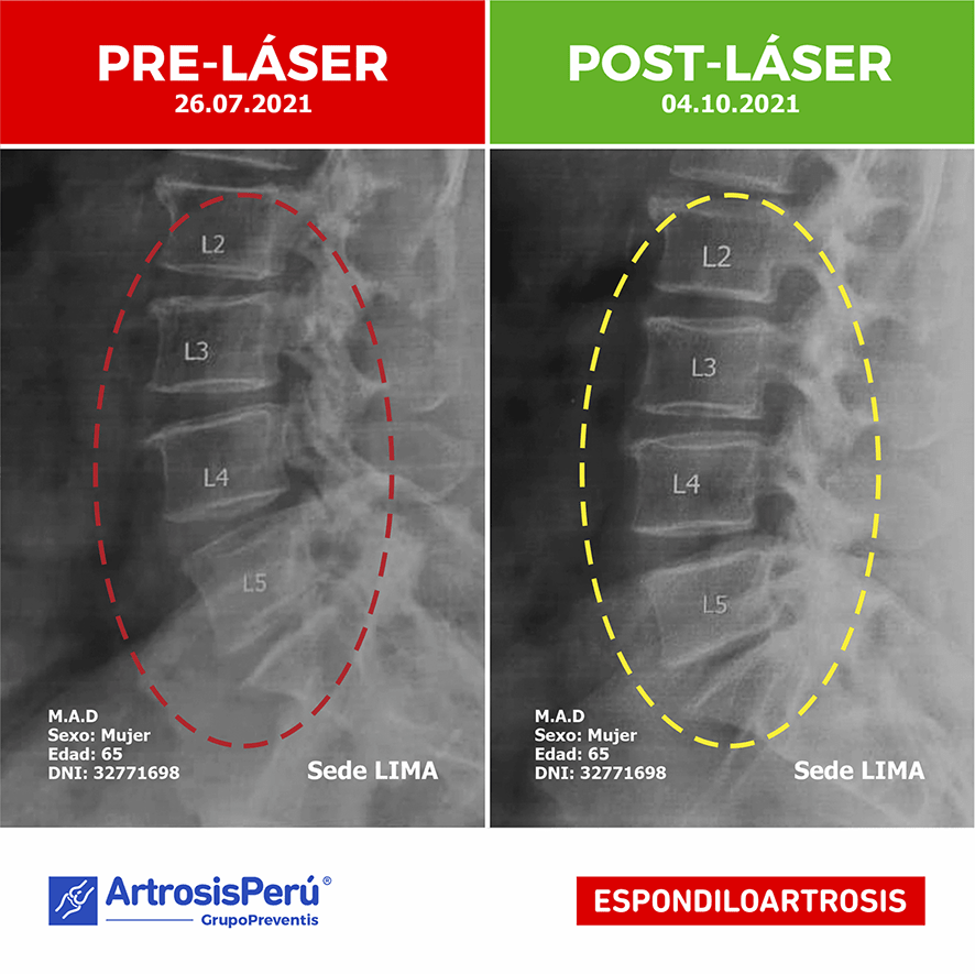 ESPONDILOARTROSIS - Fundación Preventis