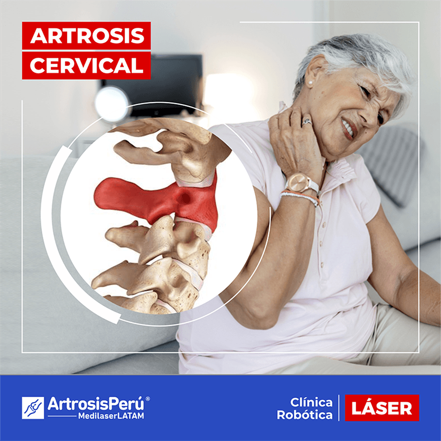 ARTROSIS CERVICAL - Fundación Preventis